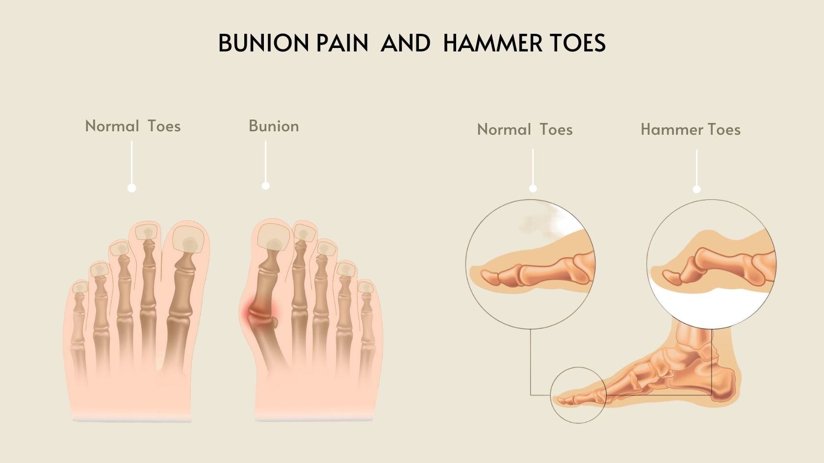 Bunion Pain, Hammer Toes- Women's Foot Problems And Their Best Treatment